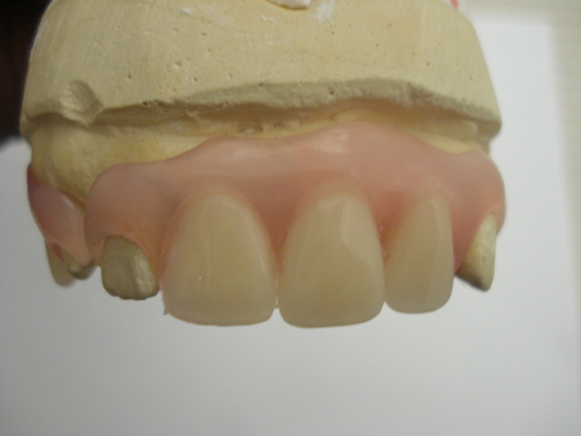 Streamline Dental Lab - Manhattan, New York - Gallery - Dentures - Tcs ...
