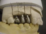 Streamline Dental Lab - Manhattan, New York - Gallery - Implants ...