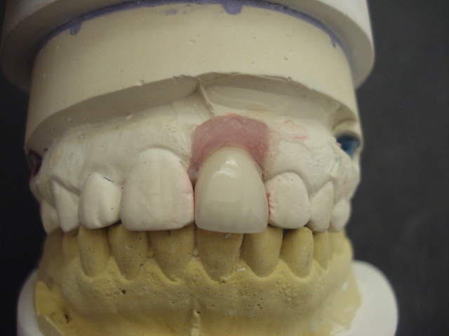 Streamline Dental Lab - Manhattan, New York - Gallery - Implants ...