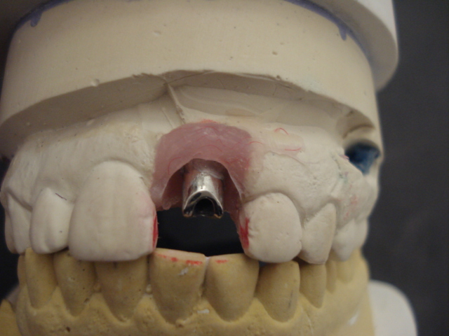 Streamline Dental Lab - Manhattan, New York - Gallery - Implants ...