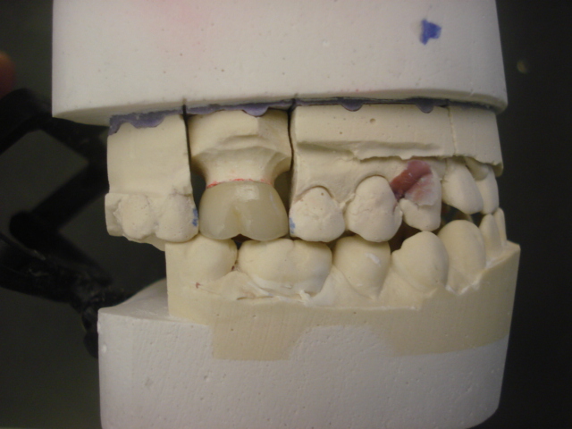 Streamline Dental Lab - Manhattan, New York - Gallery - Pfm - Captek