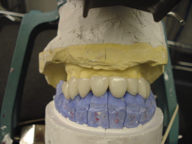 Streamline Dental Lab - Manhattan, New York - Gallery - All Ceramic ...
