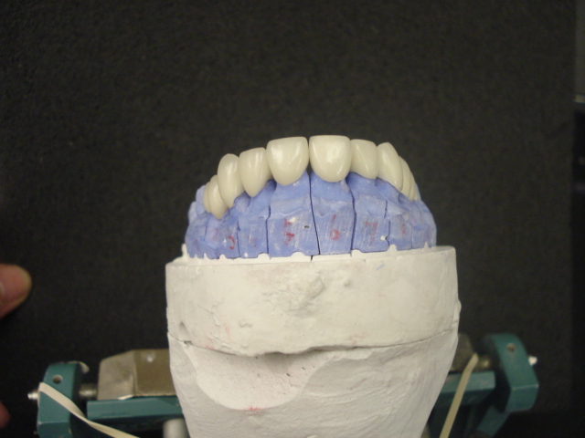 Streamline Dental Lab - Manhattan, New York - Gallery - All Ceramic ...