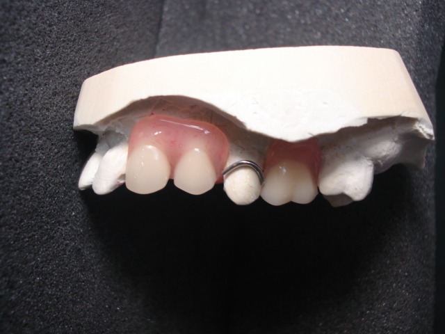 Streamline Dental Lab - Manhattan, New York - Gallery - Dentures ...