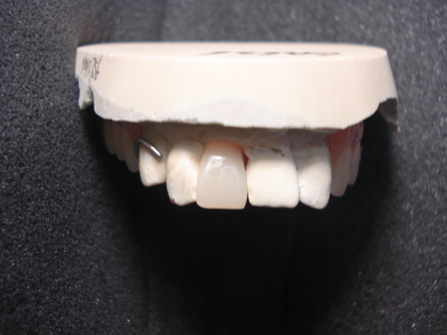 Streamline Dental Lab - Manhattan, New York - Gallery - Dentures ...