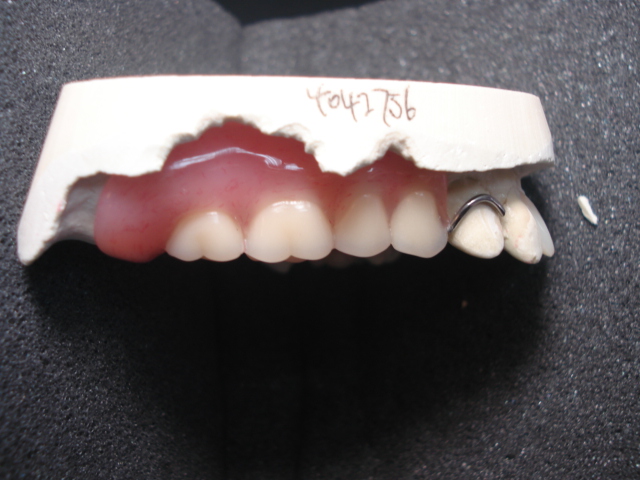 Streamline Dental Lab - Manhattan, New York - Gallery - Dentures ...