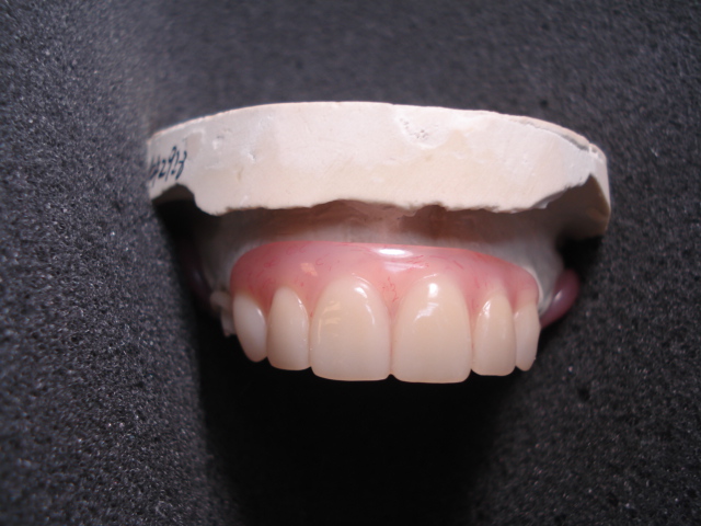 Streamline Dental Lab - Manhattan, New York - Gallery - Dentures ...