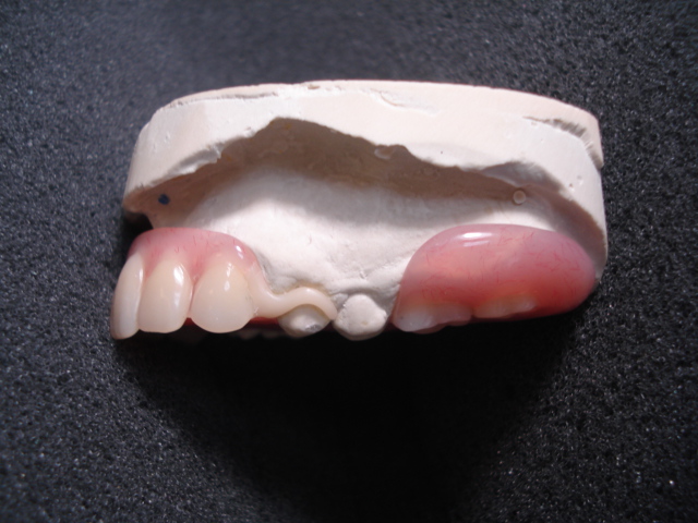 Streamline Dental Lab - Manhattan, New York - Gallery - Dentures ...