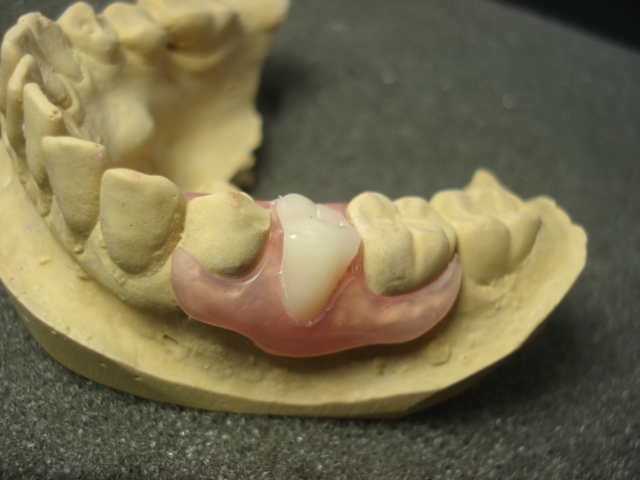 Streamline Dental Lab - Manhattan, New York - Gallery - Dentures - Tcs ...