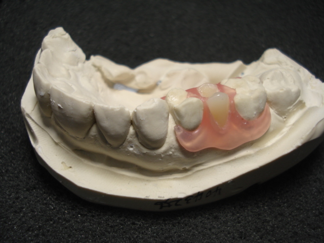 Streamline Dental Lab - Manhattan, New York - Gallery - Dentures - Tcs ...