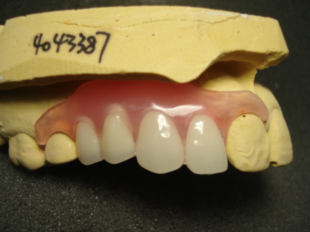 Streamline Dental Lab - Manhattan, New York - Gallery - Dentures - Tcs ...