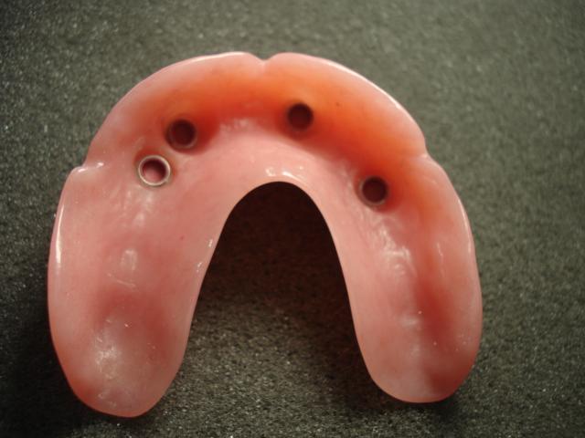 Streamline Dental Lab - Manhattan, New York - Gallery - Dentures - Full ...