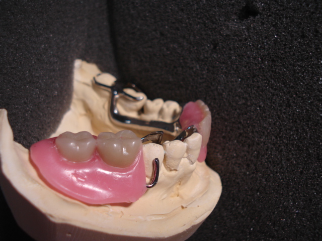 Streamline Dental Lab - Manhattan, New York - Gallery - Dentures ...