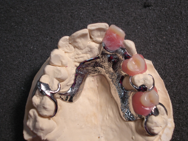 Streamline Dental Lab - Manhattan, New York - Gallery - Dentures ...