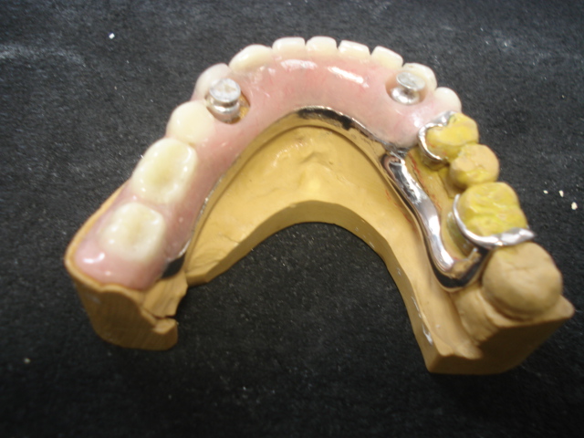 Streamline Dental Lab - Manhattan, New York - Gallery - Dentures ...